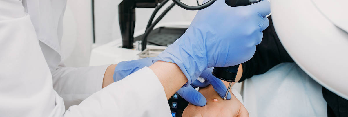 Liquid Nitrogen Treatment of Warts