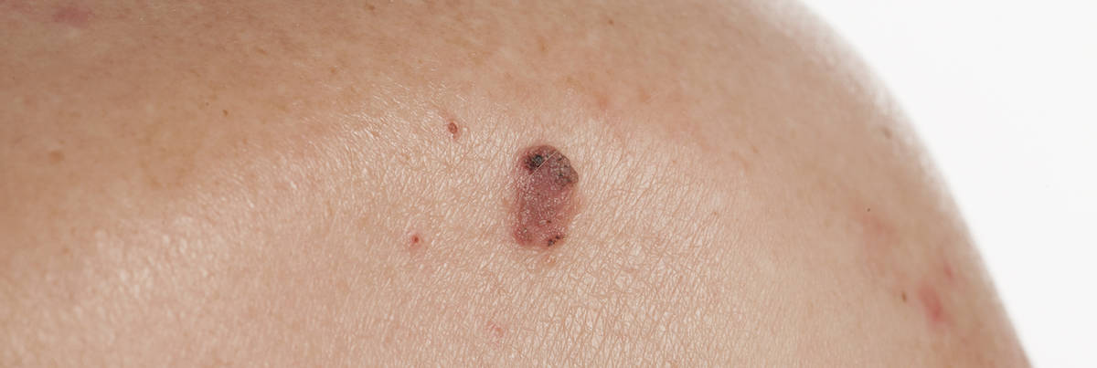 Basal Cell & Squamous Cell Carcinomas