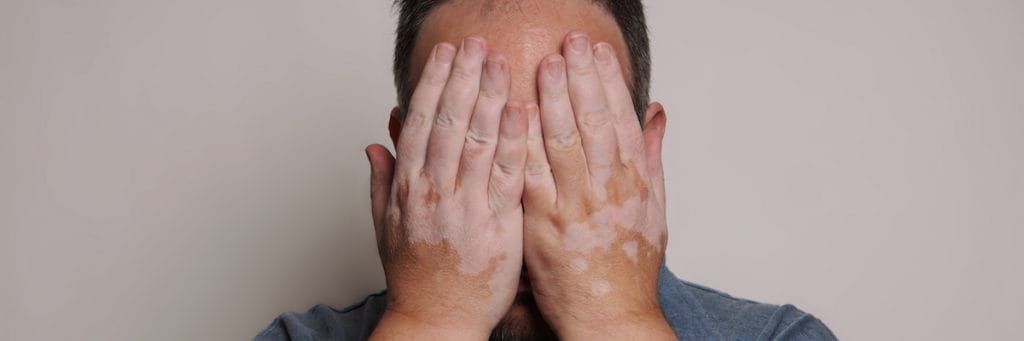 Most Common Pigmentation Disorders | The Dermatology Center Of Indiana