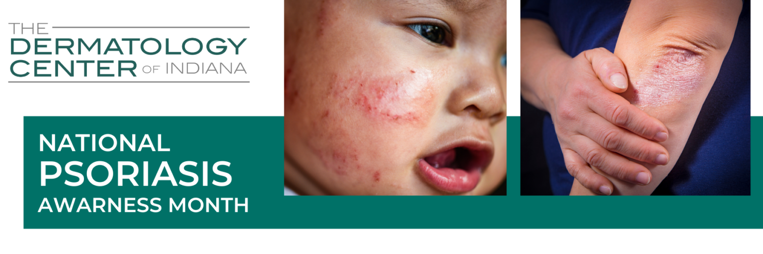 Psoriasis Symptoms and Treatment | Optima Dermatology | The Dermatology ...