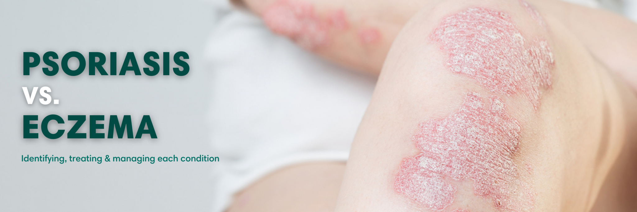 Psoriasis vs. Eczema: Identifying, treating & managing each condition ...