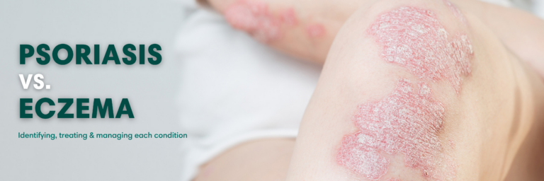Psoriasis vs. Eczema: Identifying, treating & managing each condition ...