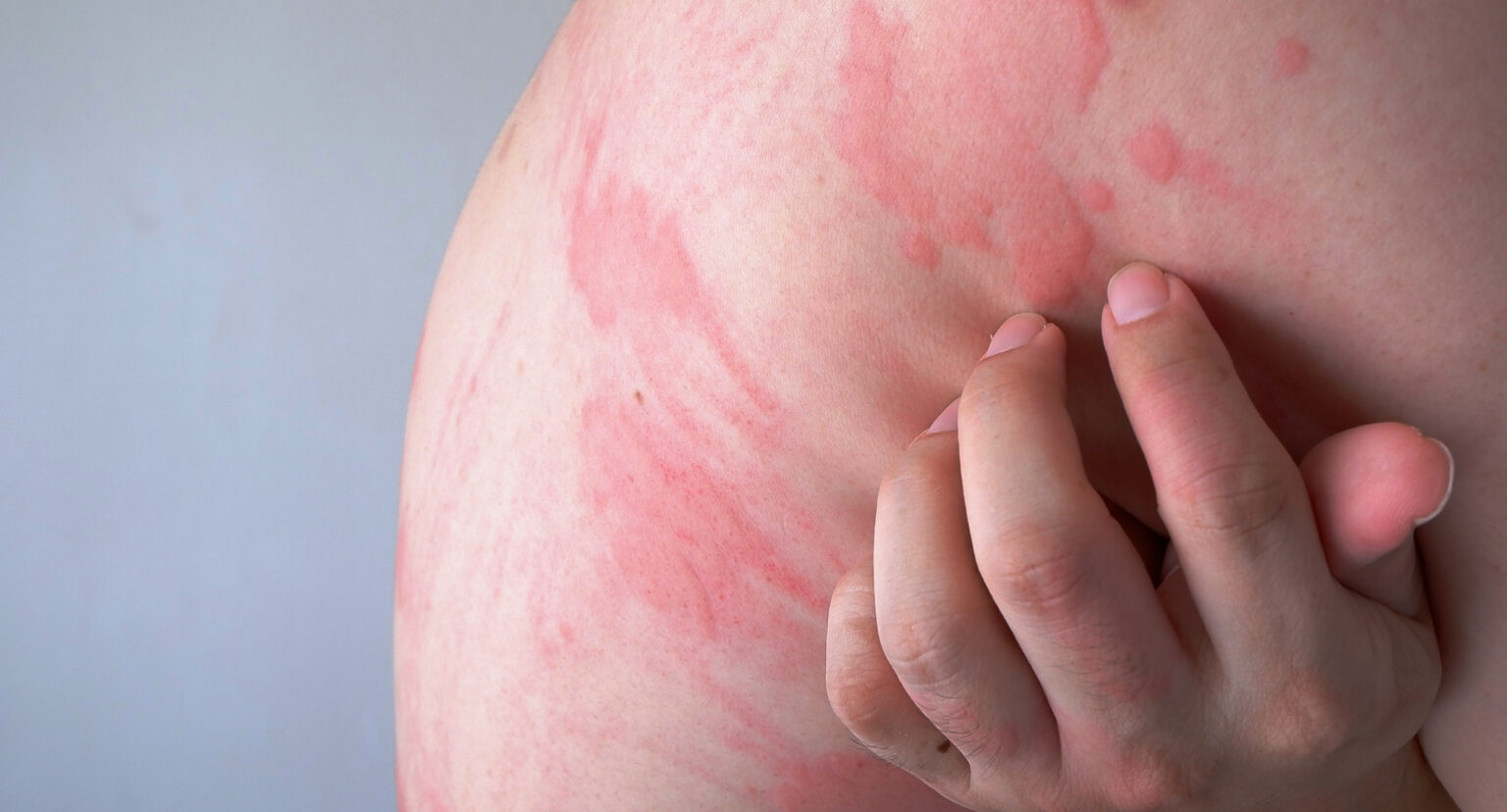 Chronic Hives in Adults | The Dermatology Center Of Indiana